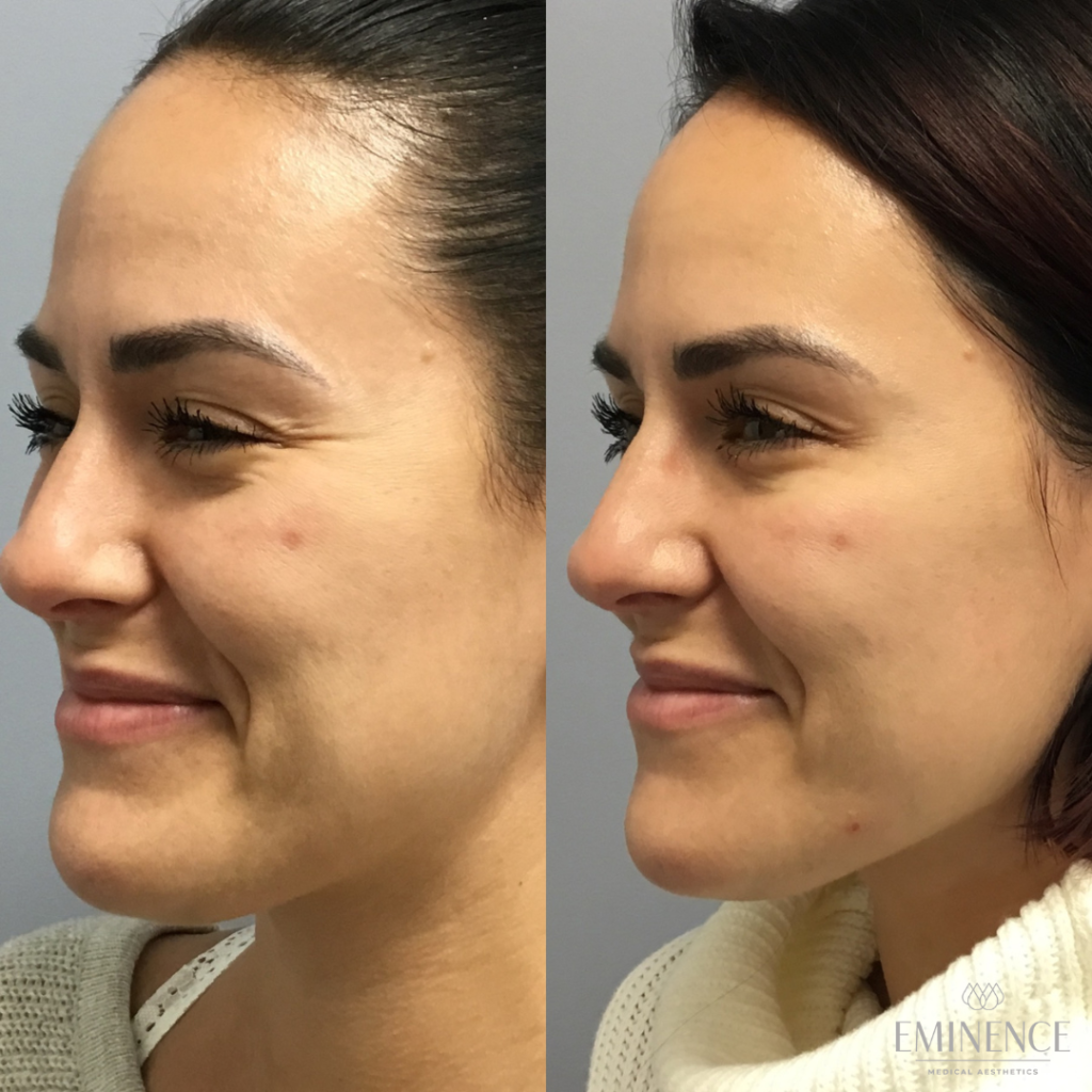 BOTOX® Cosmetic Results | Princeton, Montgomery NJ Eminence