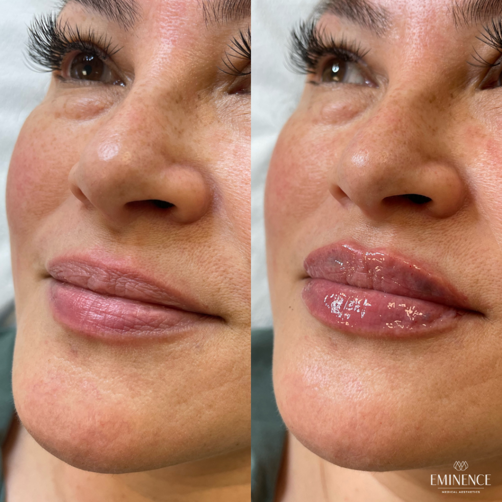 Lip Filler Results | Princeton, Montgomery NJ Eminence