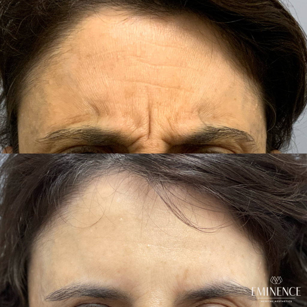 BOTOX® Cosmetic Results | Princeton, Montgomery NJ Eminence