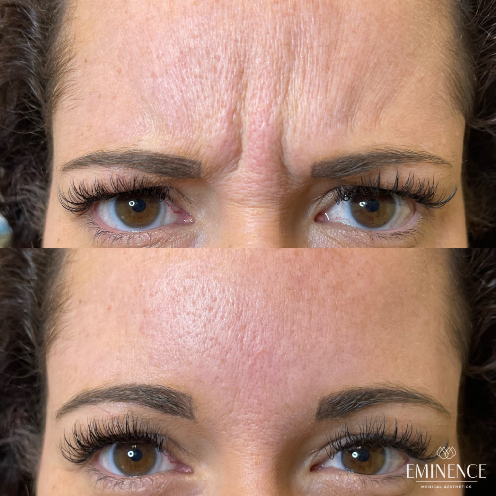 BOTOX® Cosmetic Results | Princeton, Montgomery NJ Eminence
