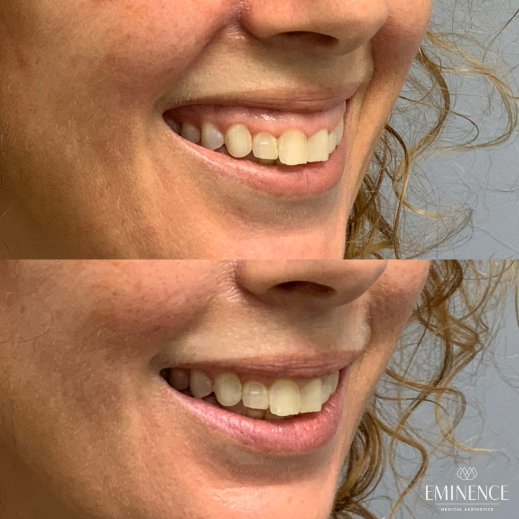 BOTOX® Cosmetic Results | Princeton, Montgomery NJ Eminence