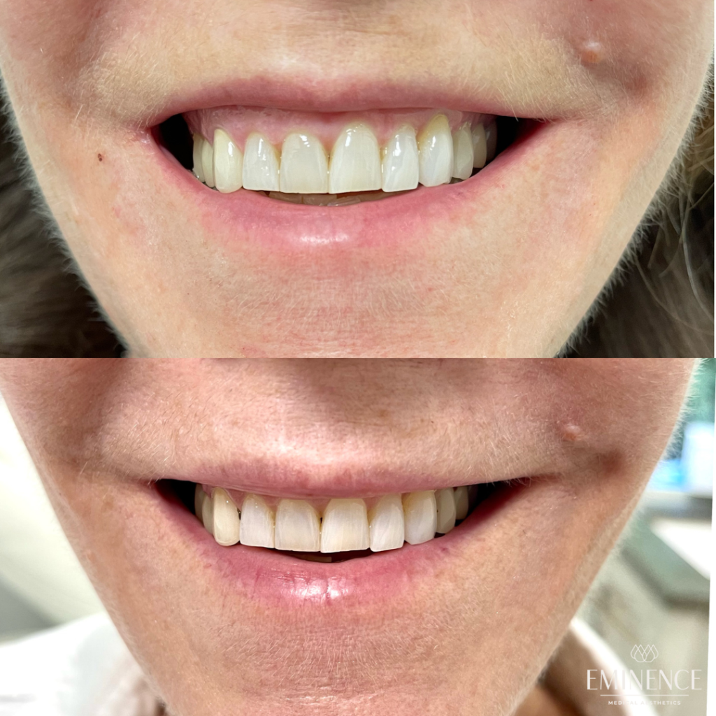 BOTOX® Cosmetic Results | Princeton, Montgomery NJ Eminence