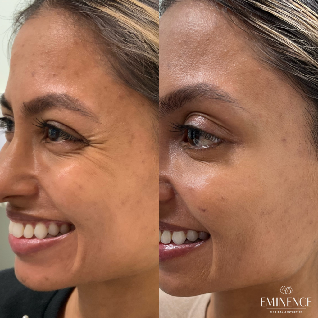 BOTOX® Cosmetic Results | Princeton, Montgomery NJ Eminence