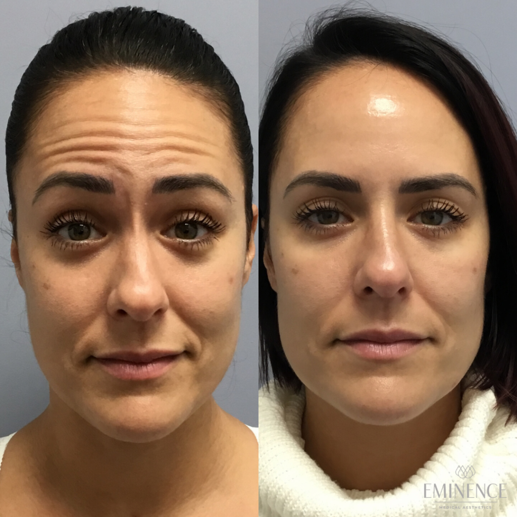 BOTOX® Cosmetic Results | Princeton, Montgomery NJ Eminence