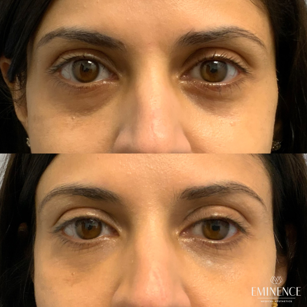 Dermal Filler Results | Princeton, Montgomery NJ Eminence