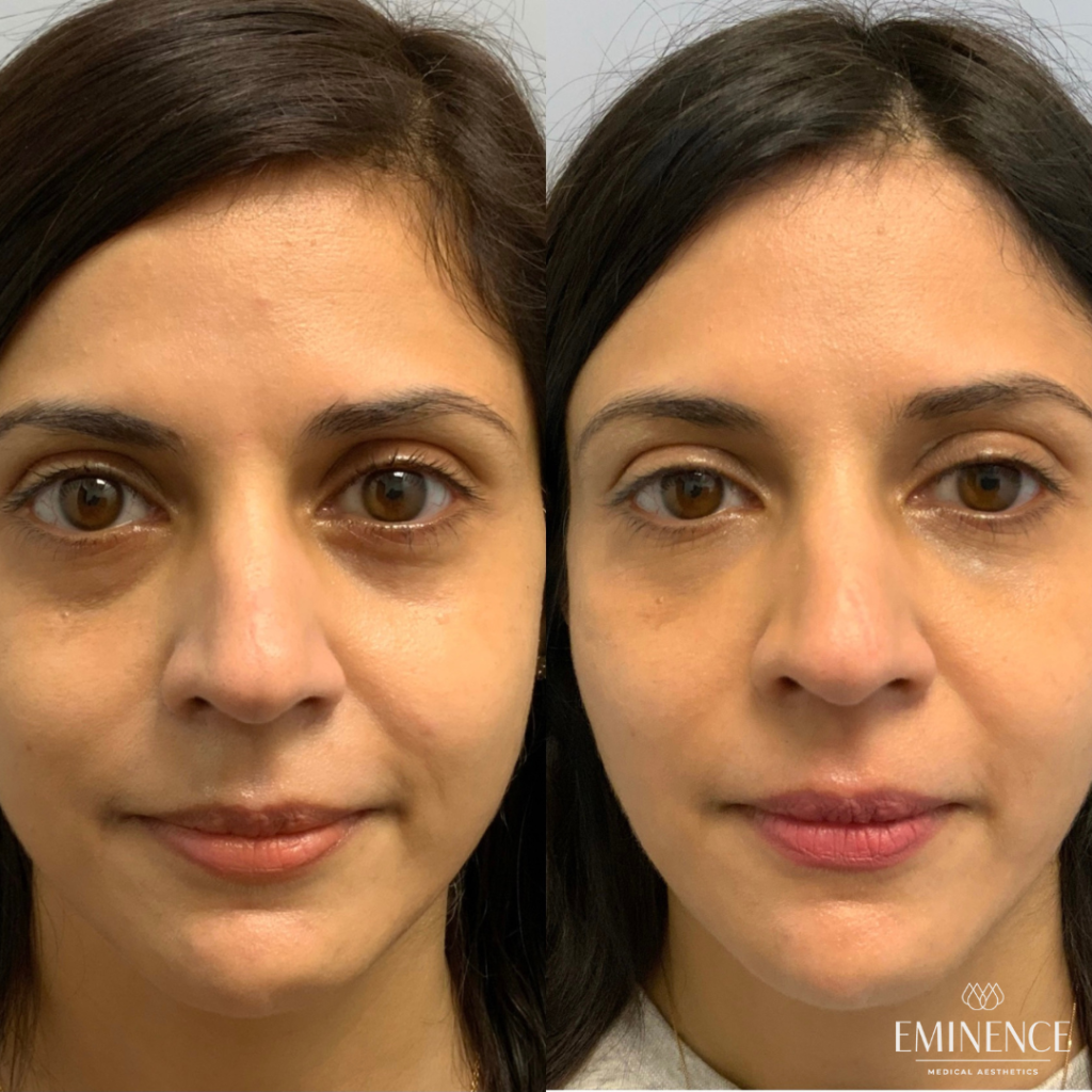 Dermal Filler Results | Princeton, Montgomery NJ Eminence