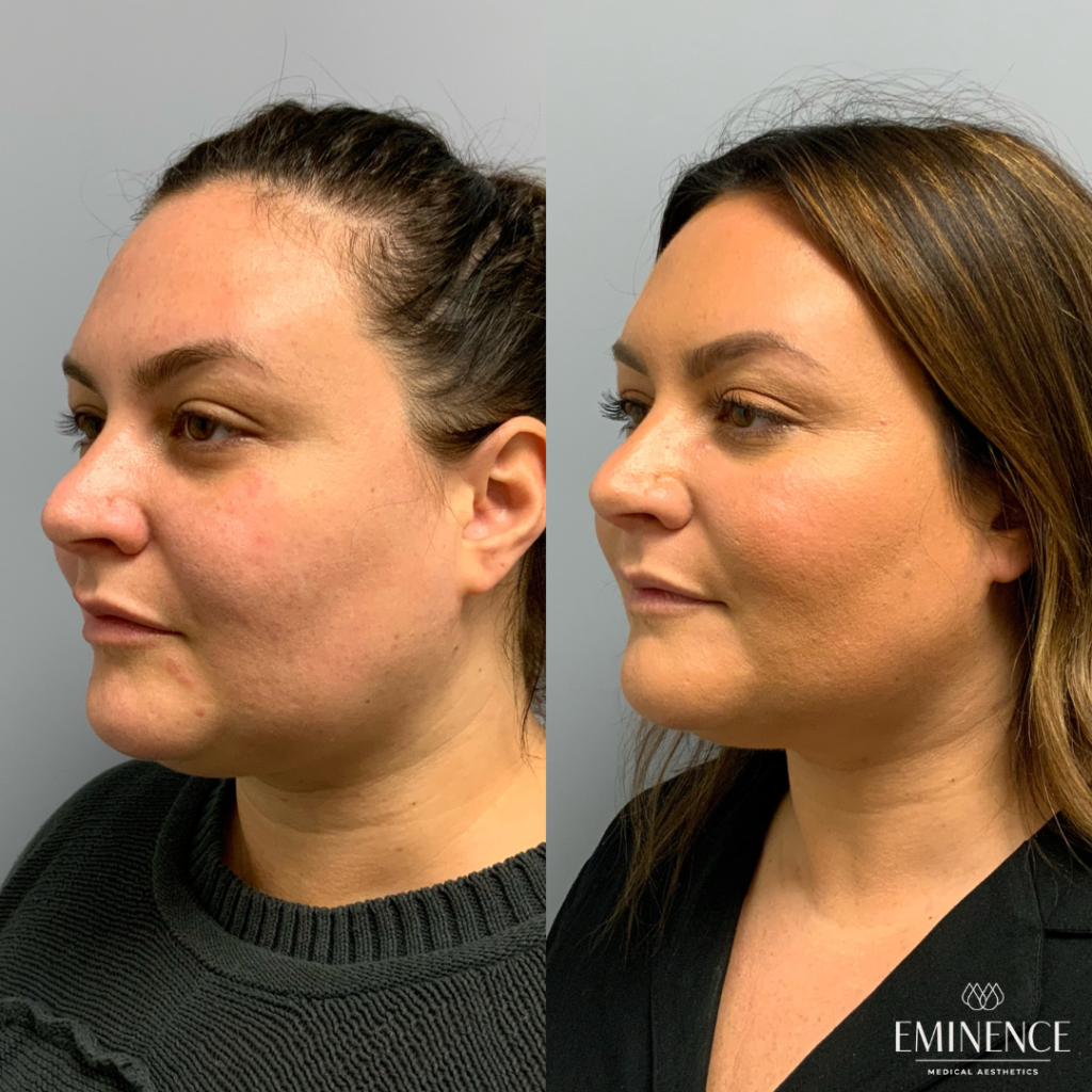 Ultherapy Results | Princeton, Montgomery NJ Eminence