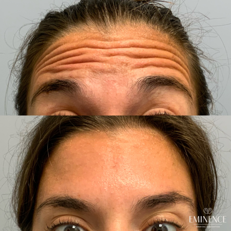 BOTOX® Cosmetic Results | Princeton, Montgomery NJ Eminence