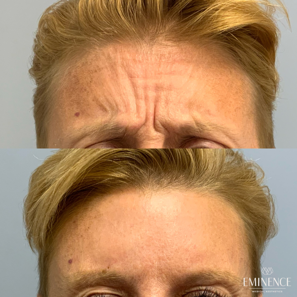 BOTOX® Cosmetic Results | Princeton, Montgomery NJ Eminence