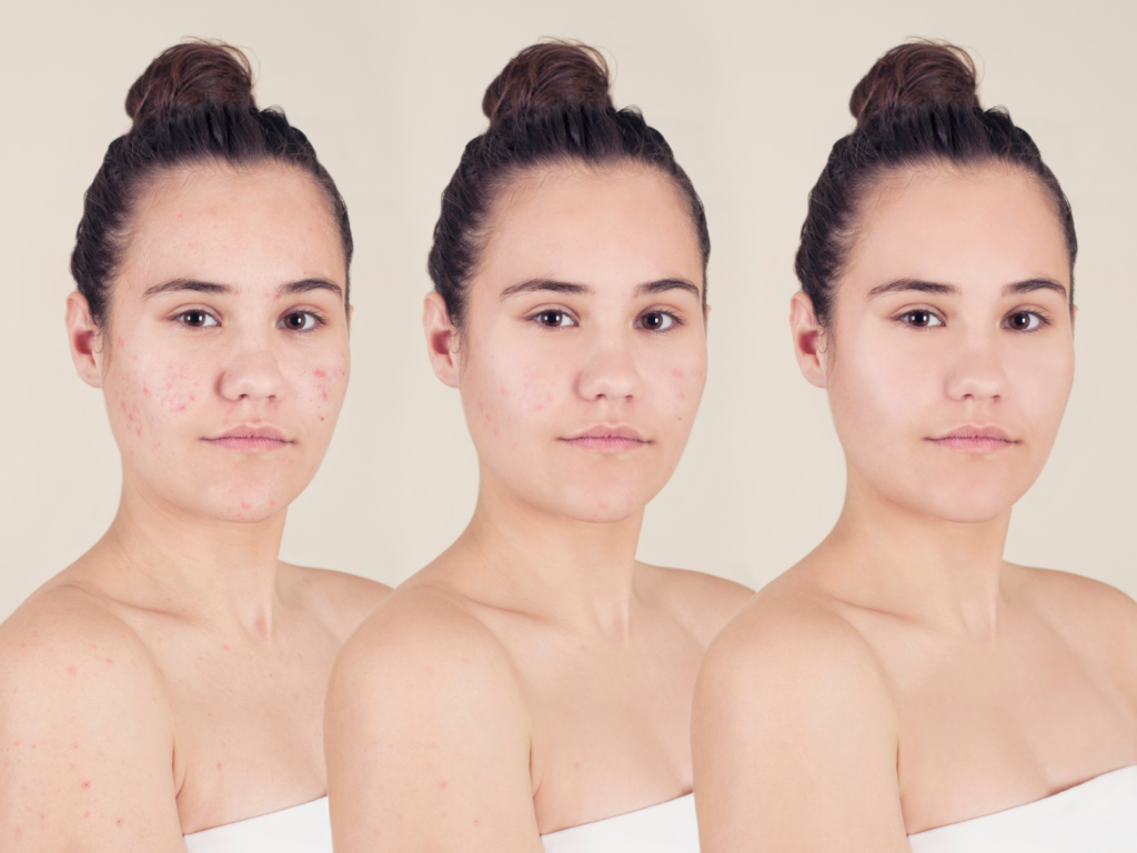 Laser Facials Princeton | Laser Genesis Facial Treatment Montgomery ...