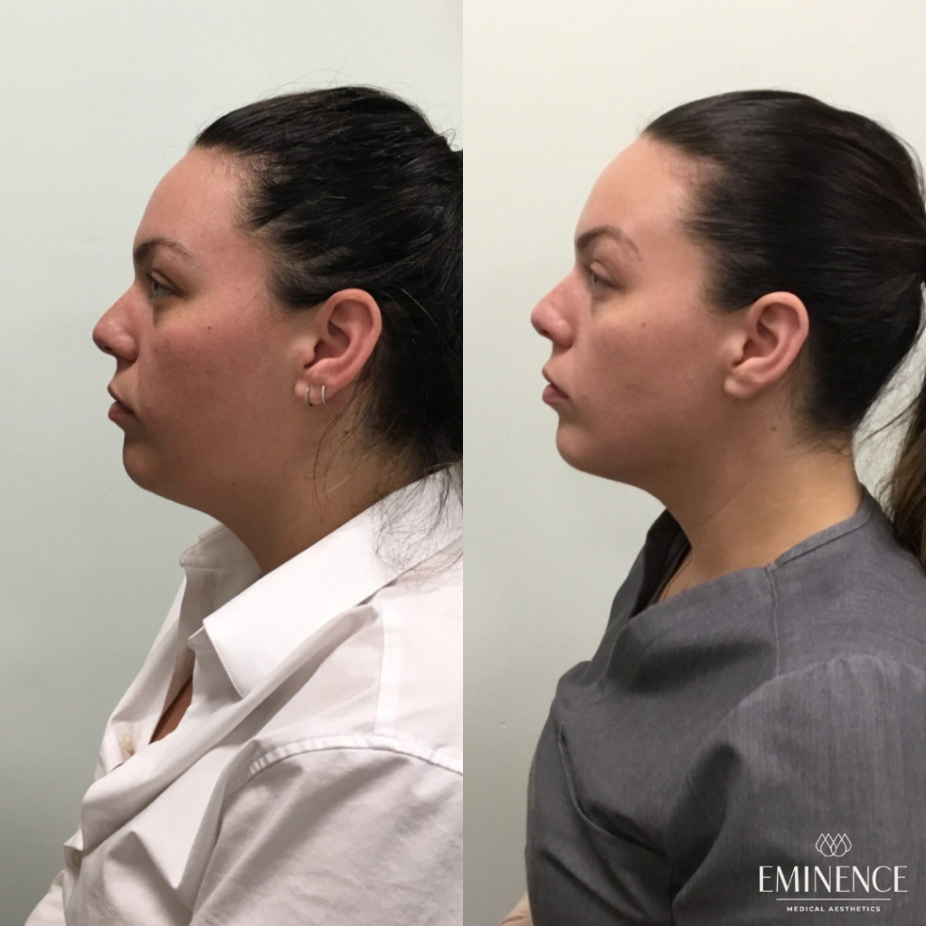 Ultherapy Results | Princeton, Montgomery NJ Eminence