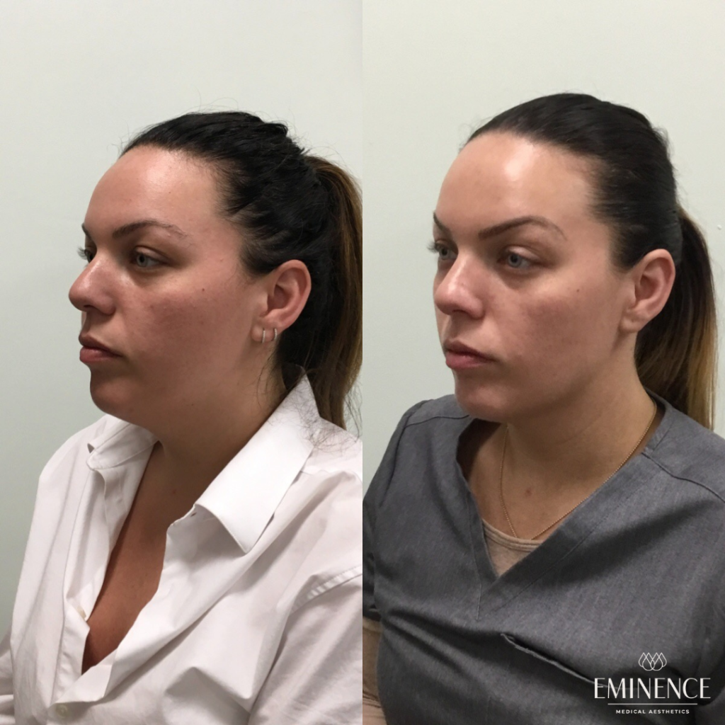 Ultherapy Results | Princeton, Montgomery NJ Eminence