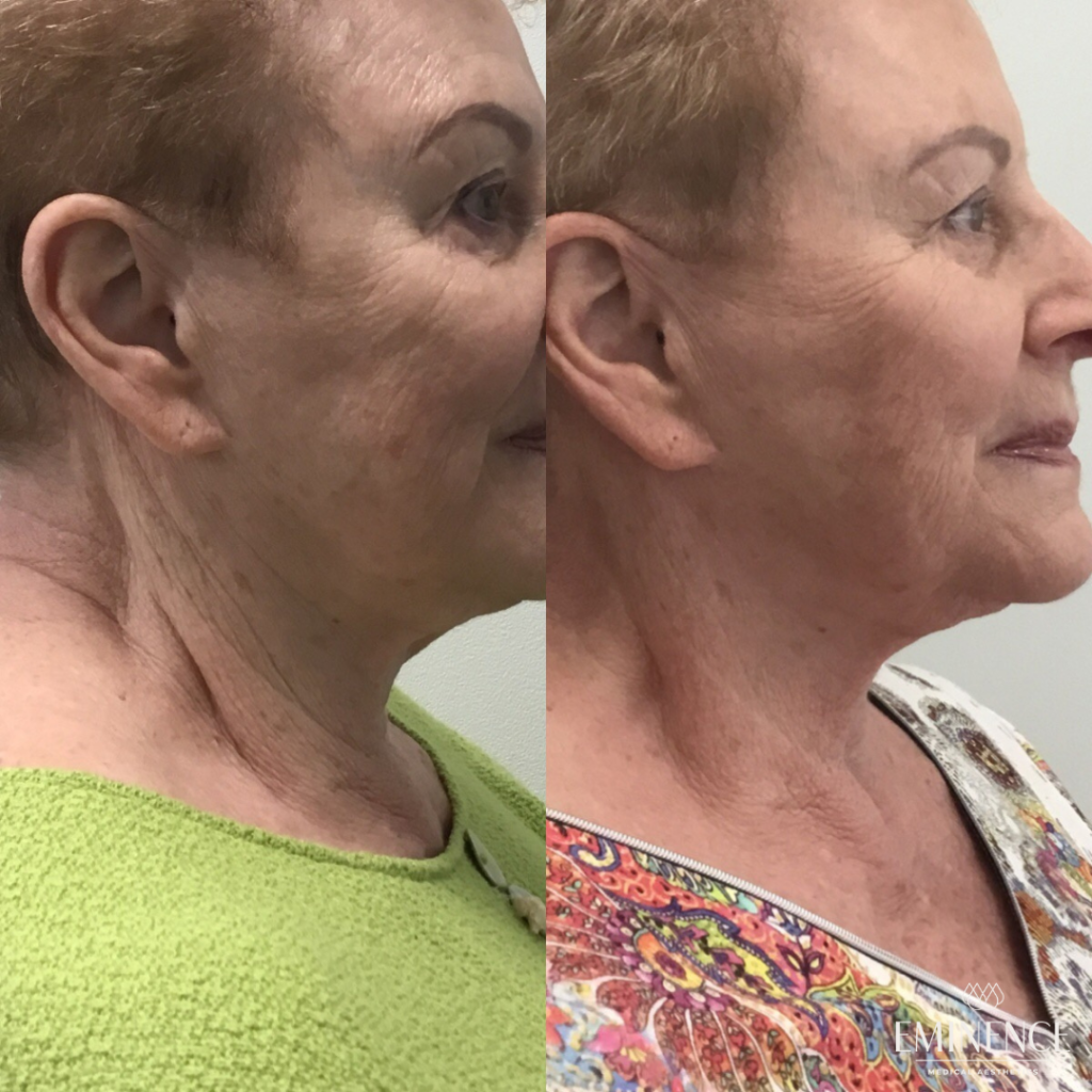 Ultherapy Results | Princeton, Montgomery NJ Eminence