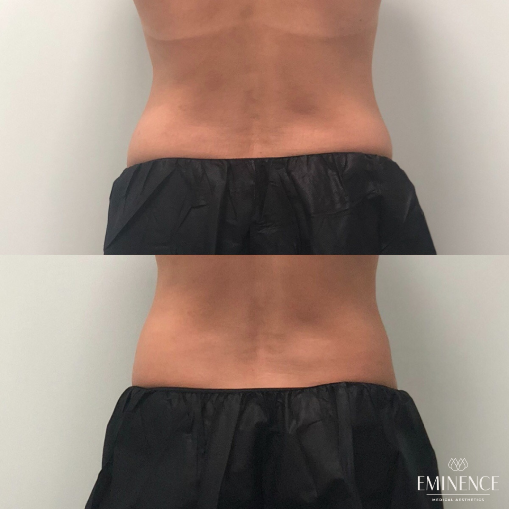 Coolsculpting Elite Results | Princeton, Montgomery NJ Eminence