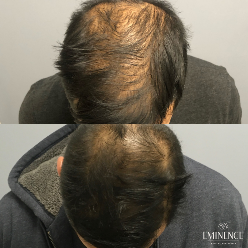 Hair Restoration Results | Princeton, Montgomery NJ Eminence