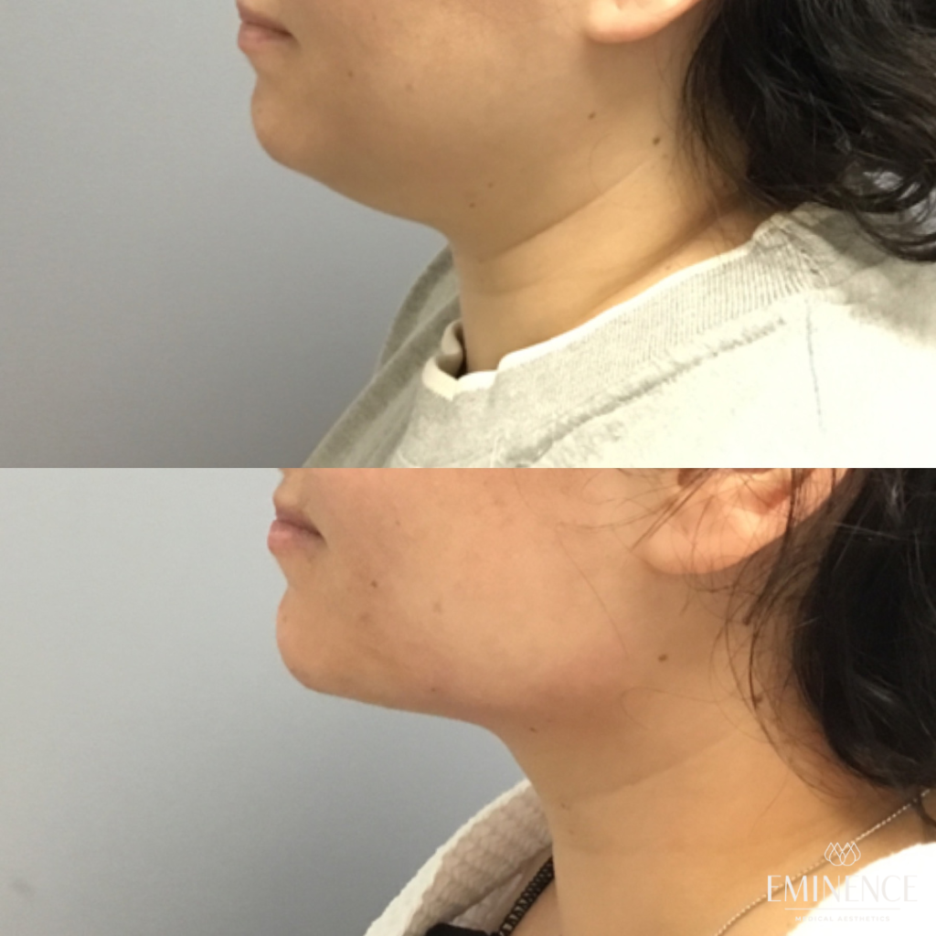 Ultherapy Results | Princeton, Montgomery NJ Eminence