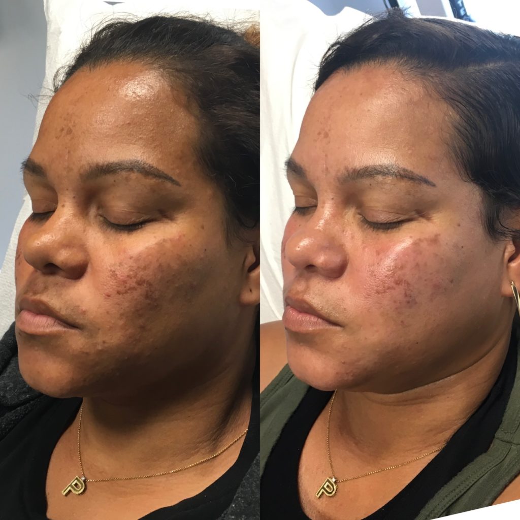 VI Peel Results | Princeton, Montgomery NJ Eminence