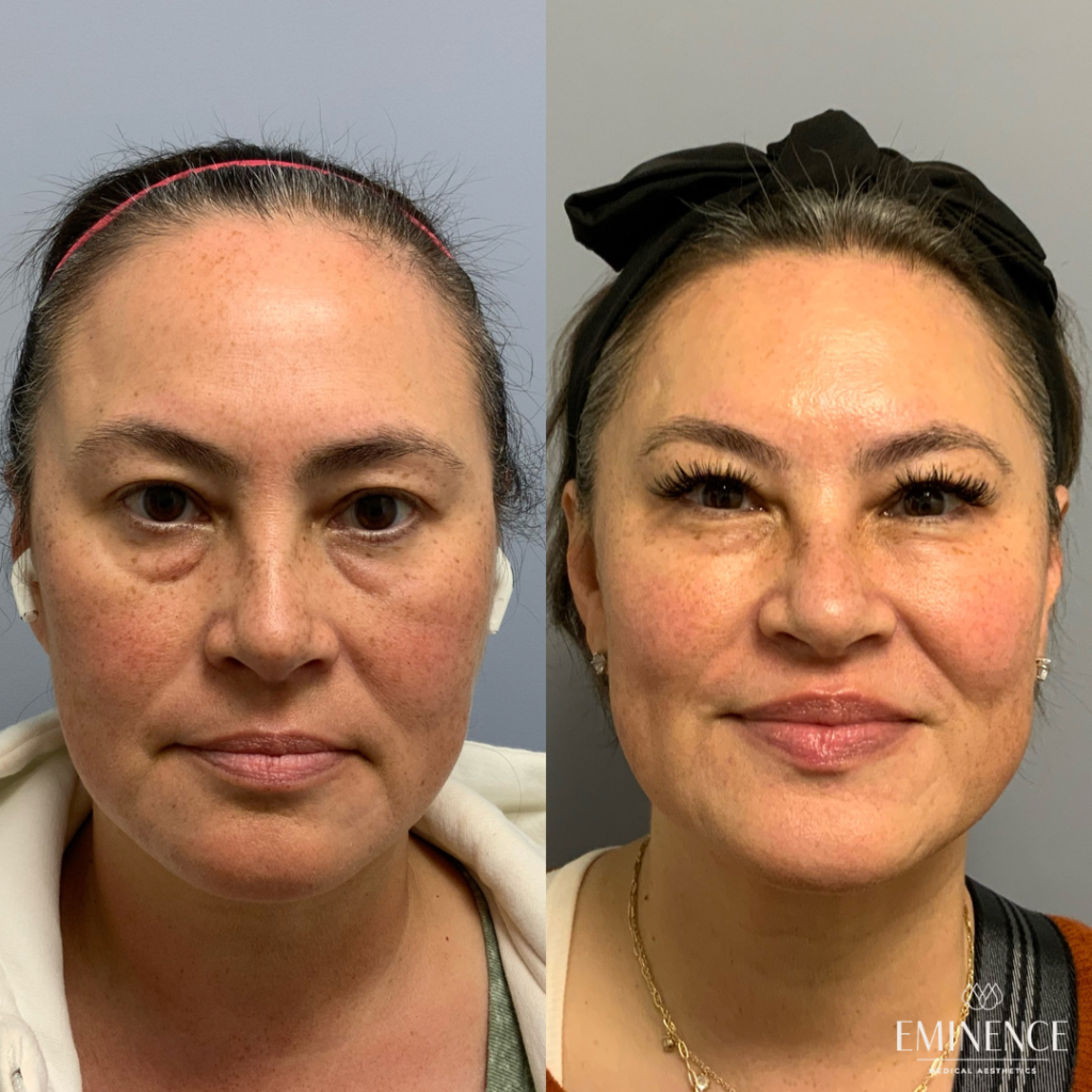 Combo Treatments | Princeton, Montgomery NJ Eminence